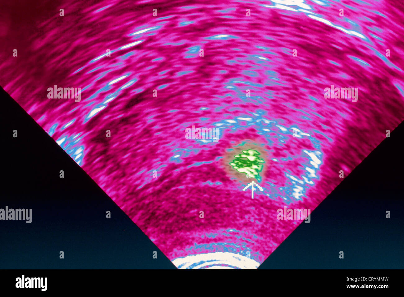 Uterine polyps hi-res stock photography and images - Alamy