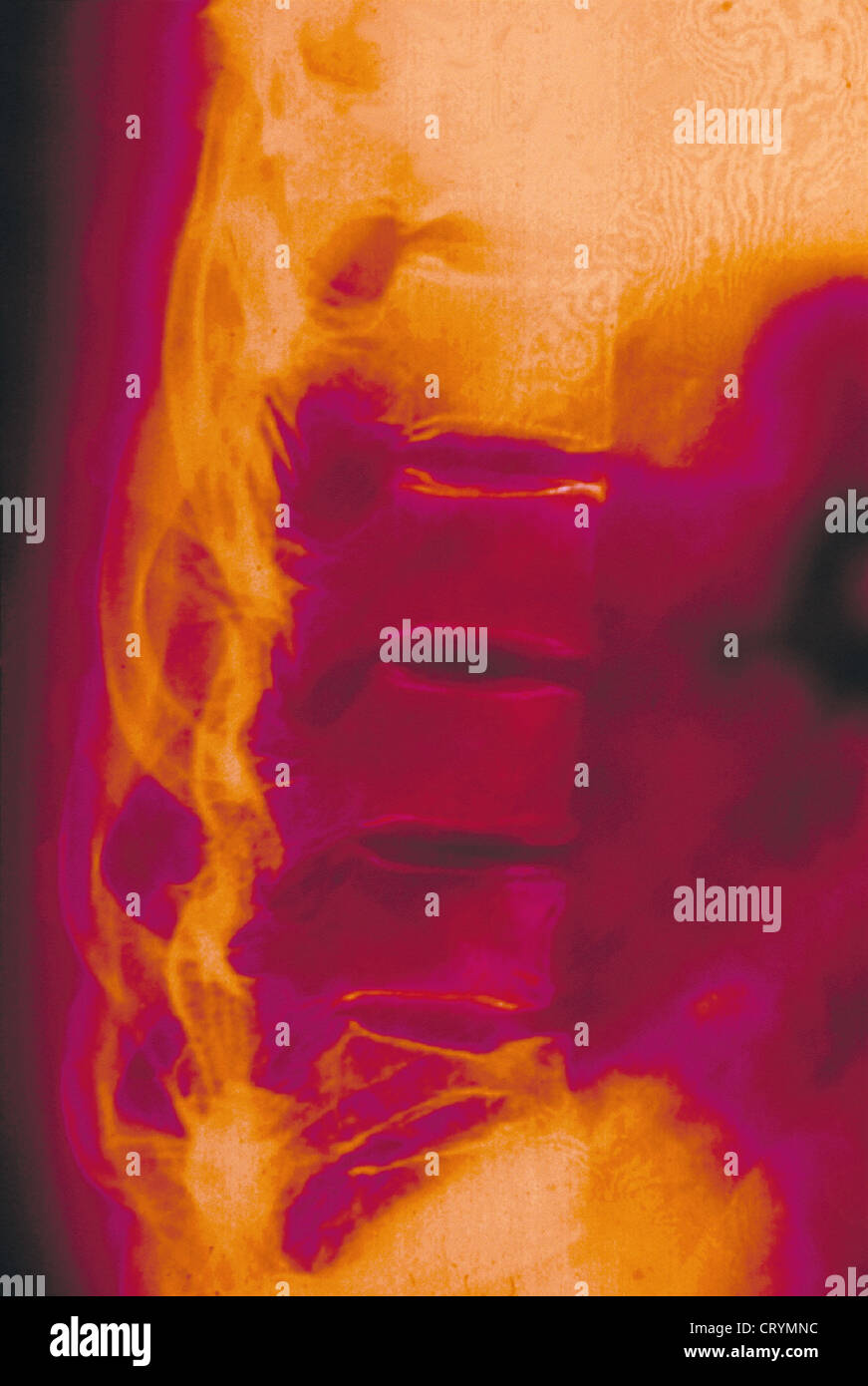 SPINAL COLUMN, X-RAY Stock Photo - Alamy