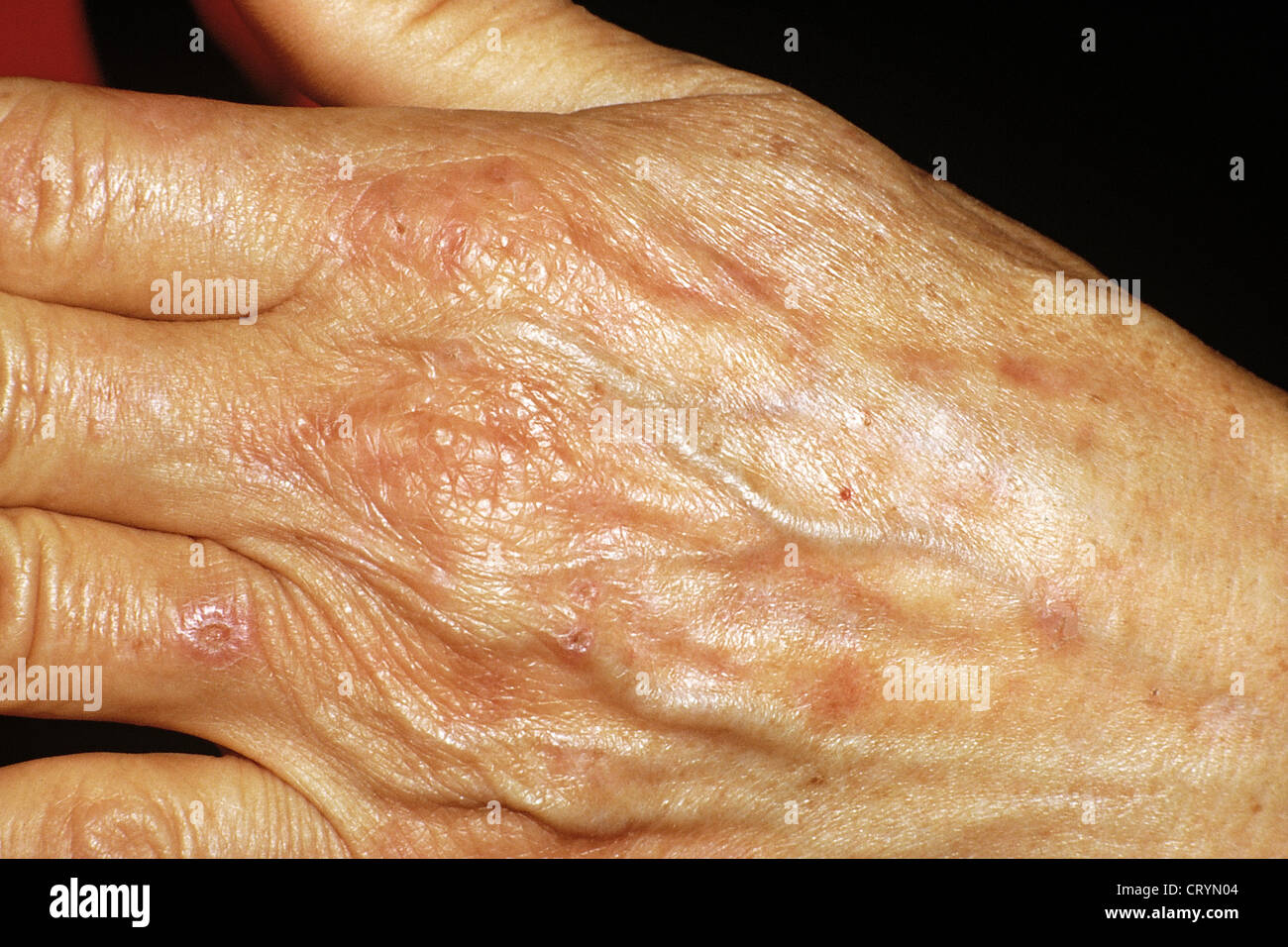 Porphyria cutanea tarda hi-res stock photography and images - Alamy