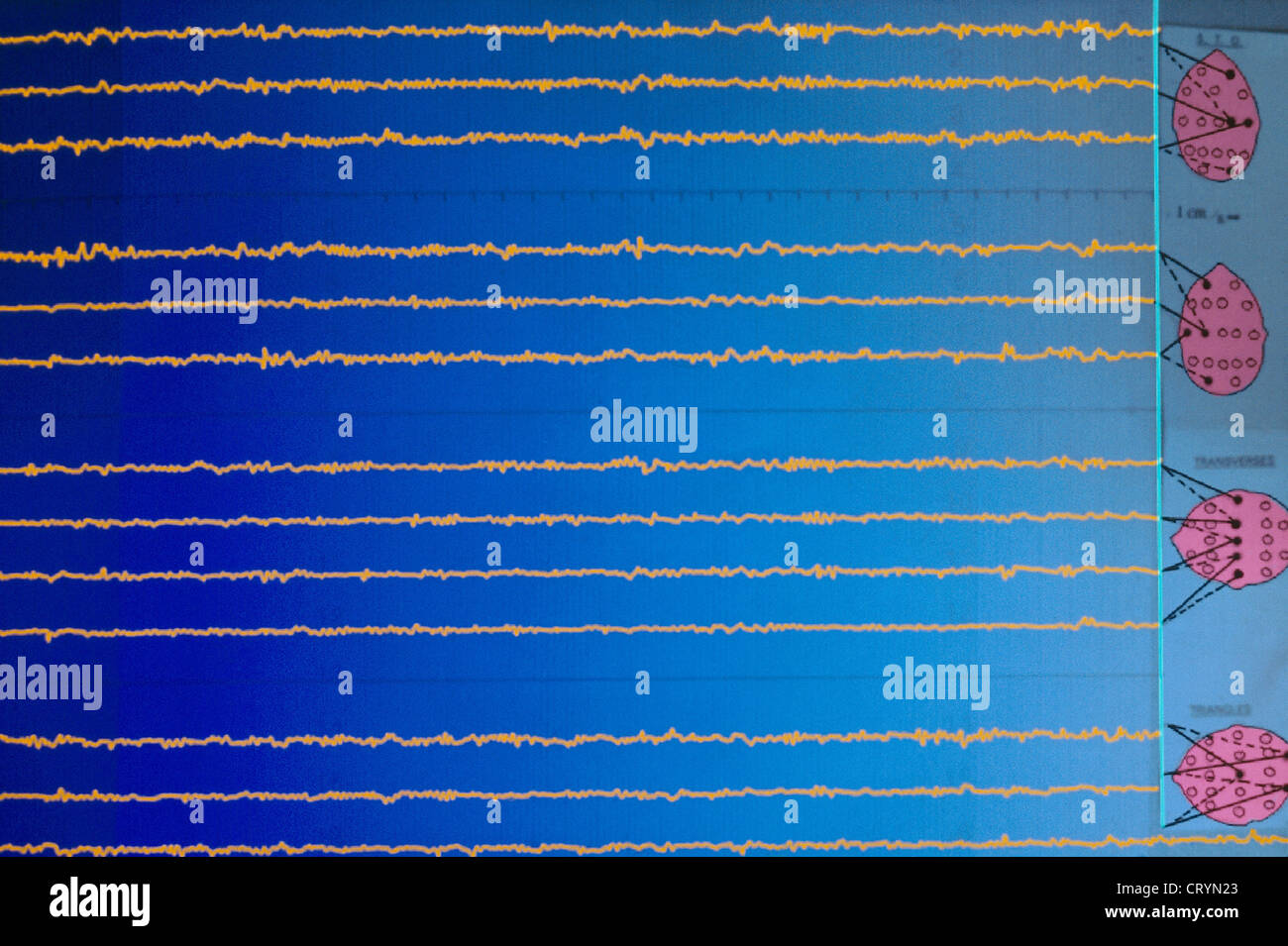 ALZHEIMER'S DISEASE, EEG Stock Photo - Alamy