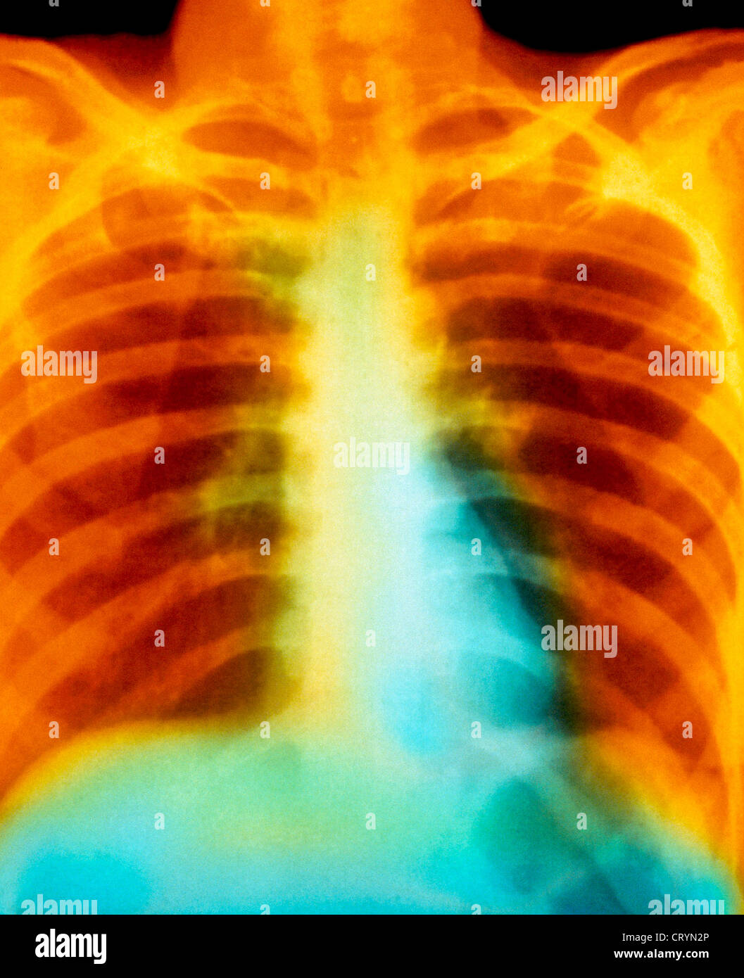 ADDISON'S DISEASE, X-RAY Stock Photo - Alamy