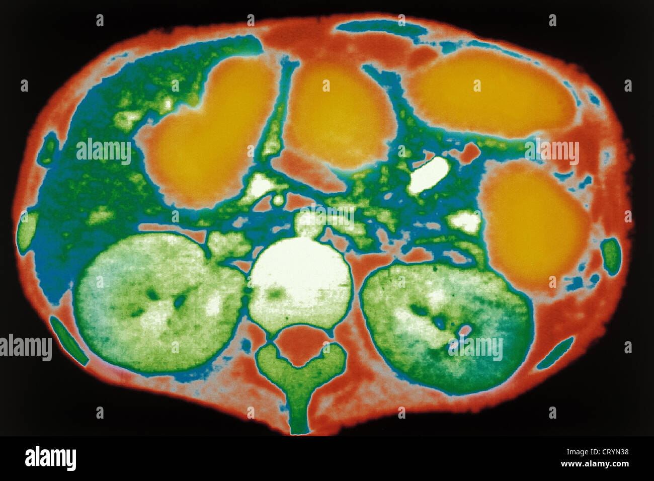 ACUTE PANCREATITIS, SCAN Stock Photo - Alamy