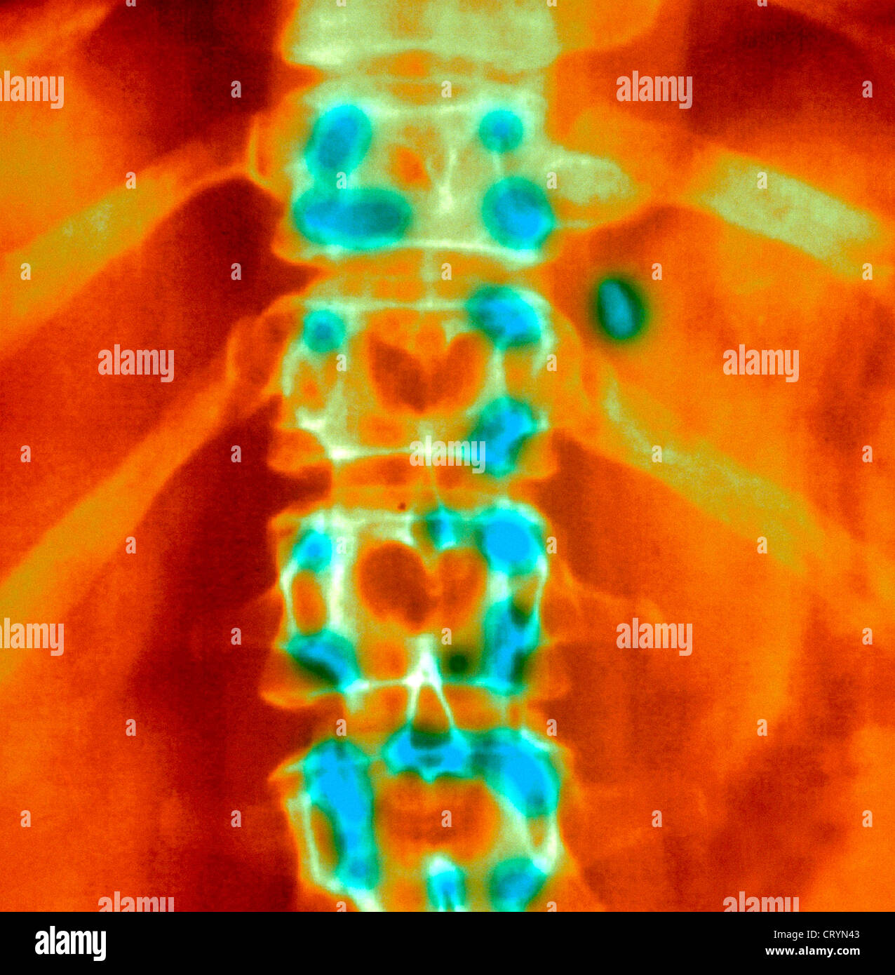 Addisons disease hi-res stock photography and images - Alamy