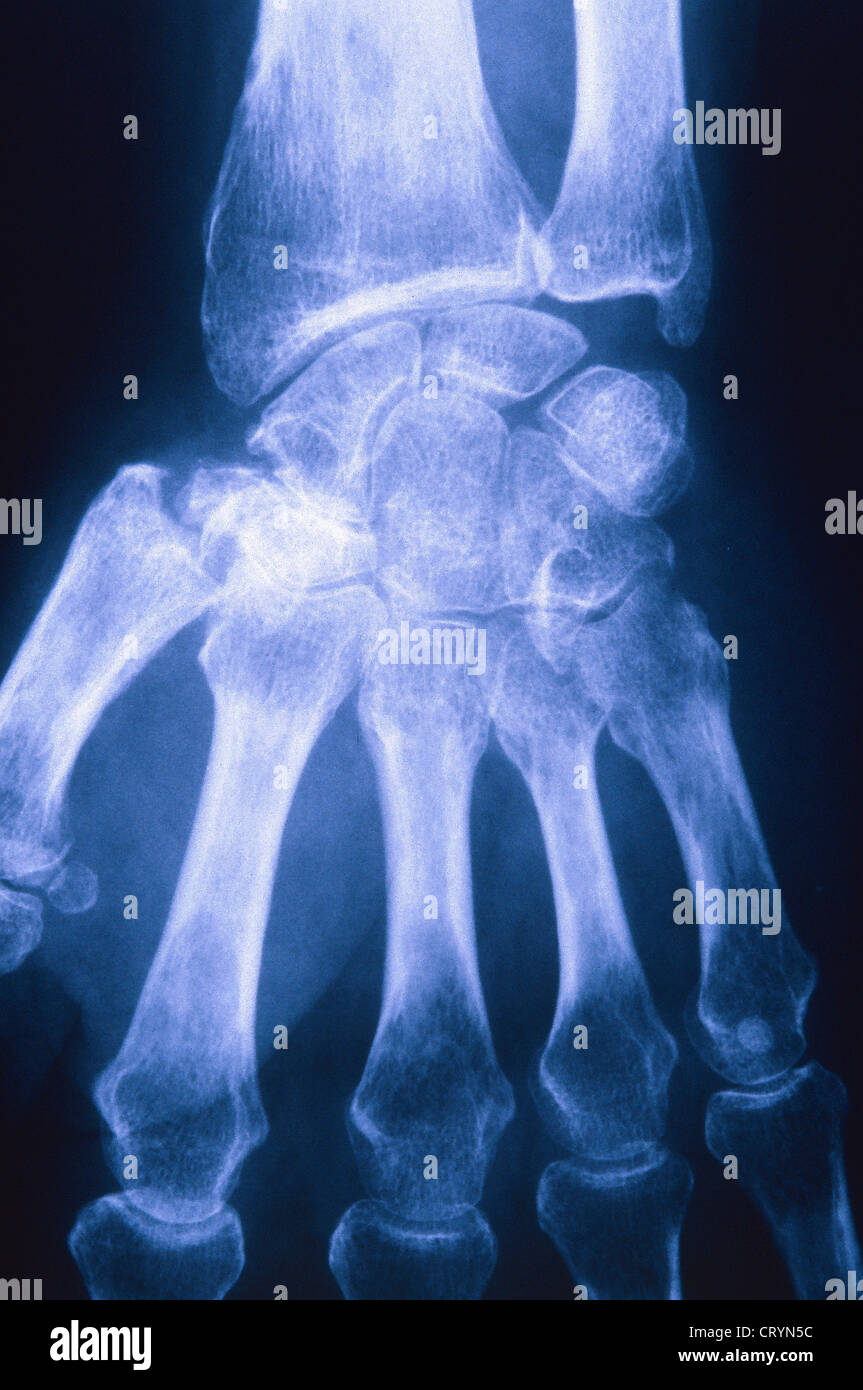 INFLAMMATION OF THE WRIST, X-RAY Stock Photo - Alamy