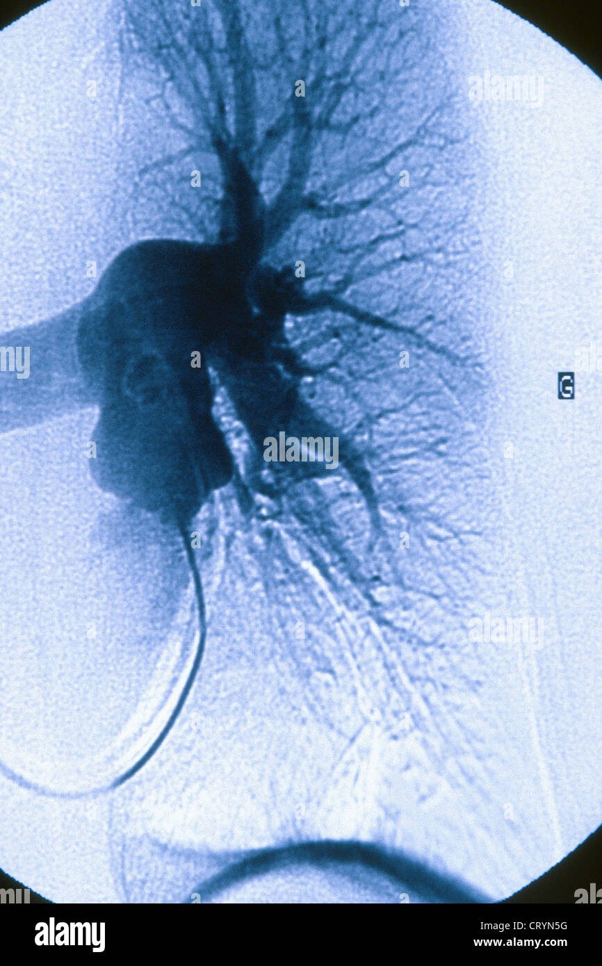 PULM. HYPERTENSION, ANGIOGRAPHY Stock Photo - Alamy