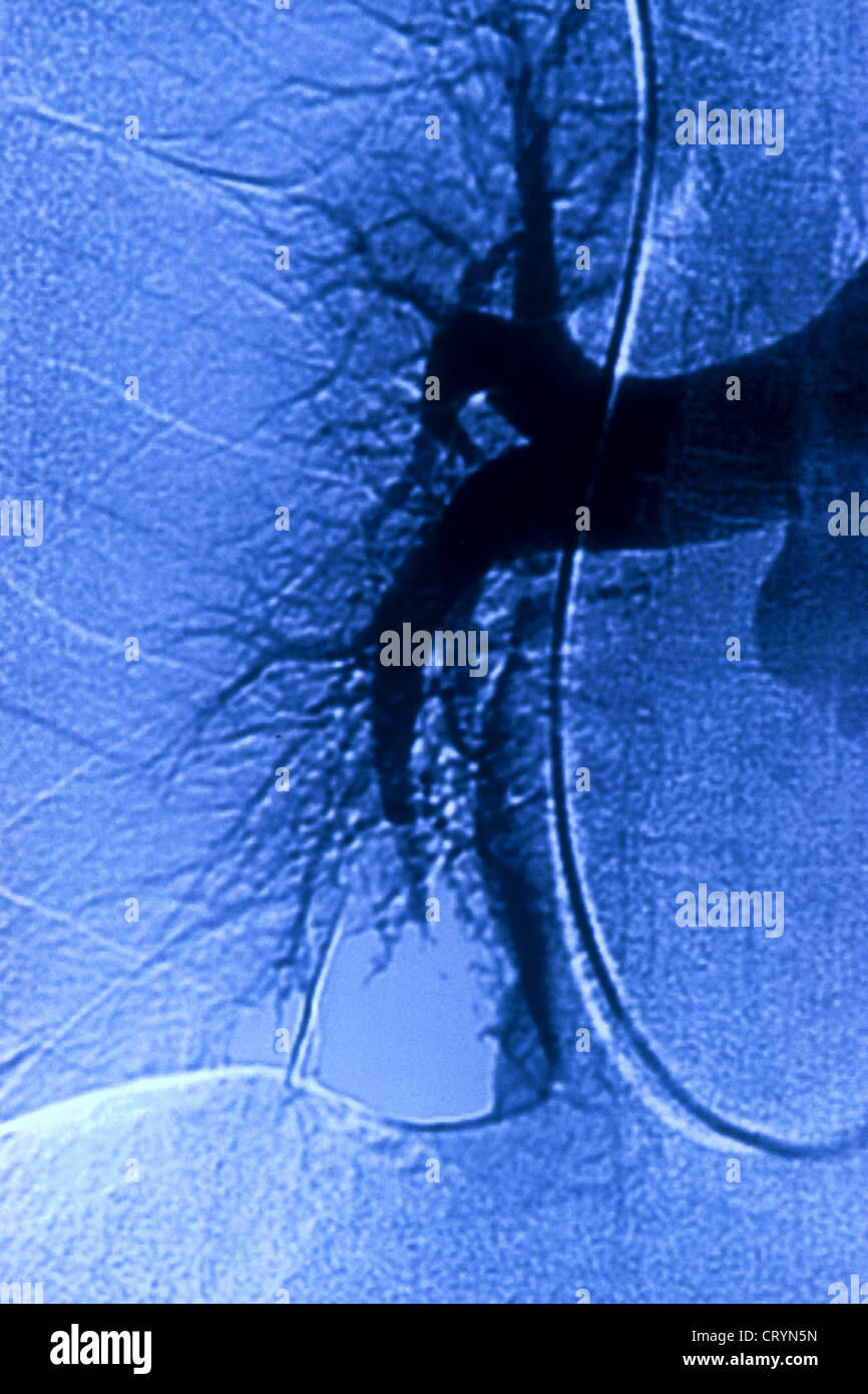 LUNG ANGIOGRAPHY FOR EMPHYSEMA Stock Photo - Alamy