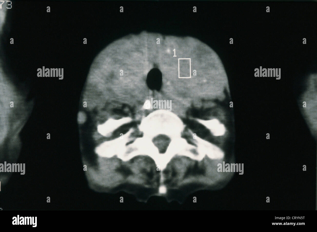 Goitres hi-res stock photography and images - Alamy