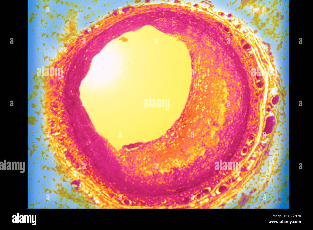 Cholesterol Atheroma High Resolution Stock Photography and Images - Alamy