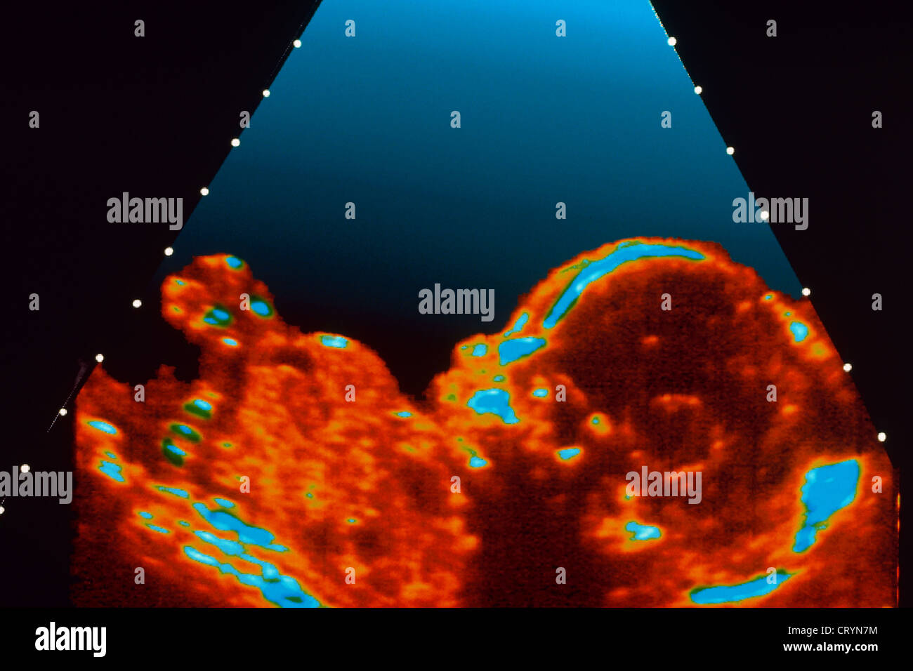 ULTRASOUND BIOMETRY OF THE FETUS Stock Photo - Alamy