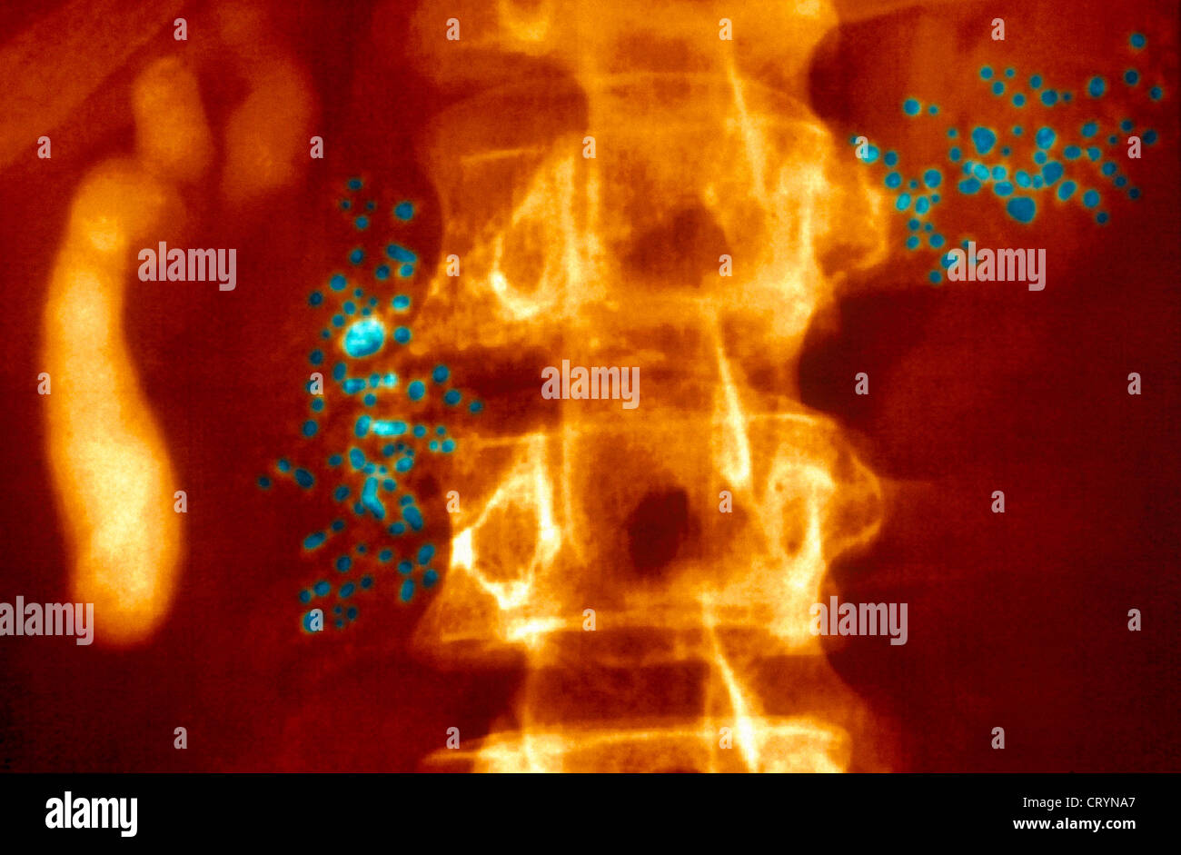 Pancreatic calculus hi-res stock photography and images - Alamy