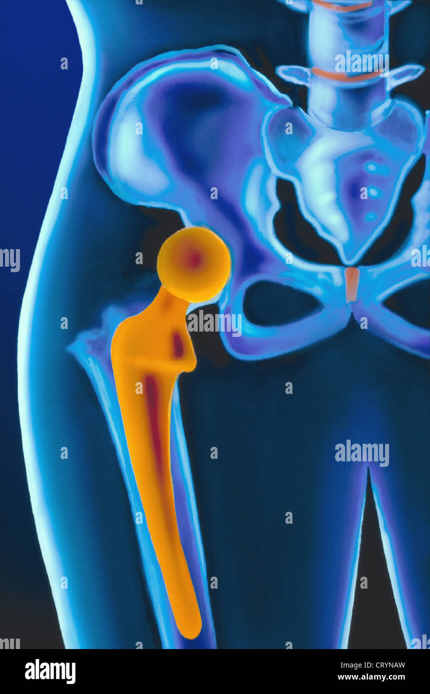 HIP PROSTHESIS, DRAWING Stock Photo - Alamy
