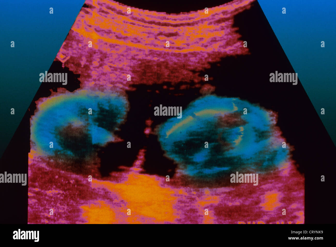 Fetal ultrasound scans hi-res stock photography and images - Alamy