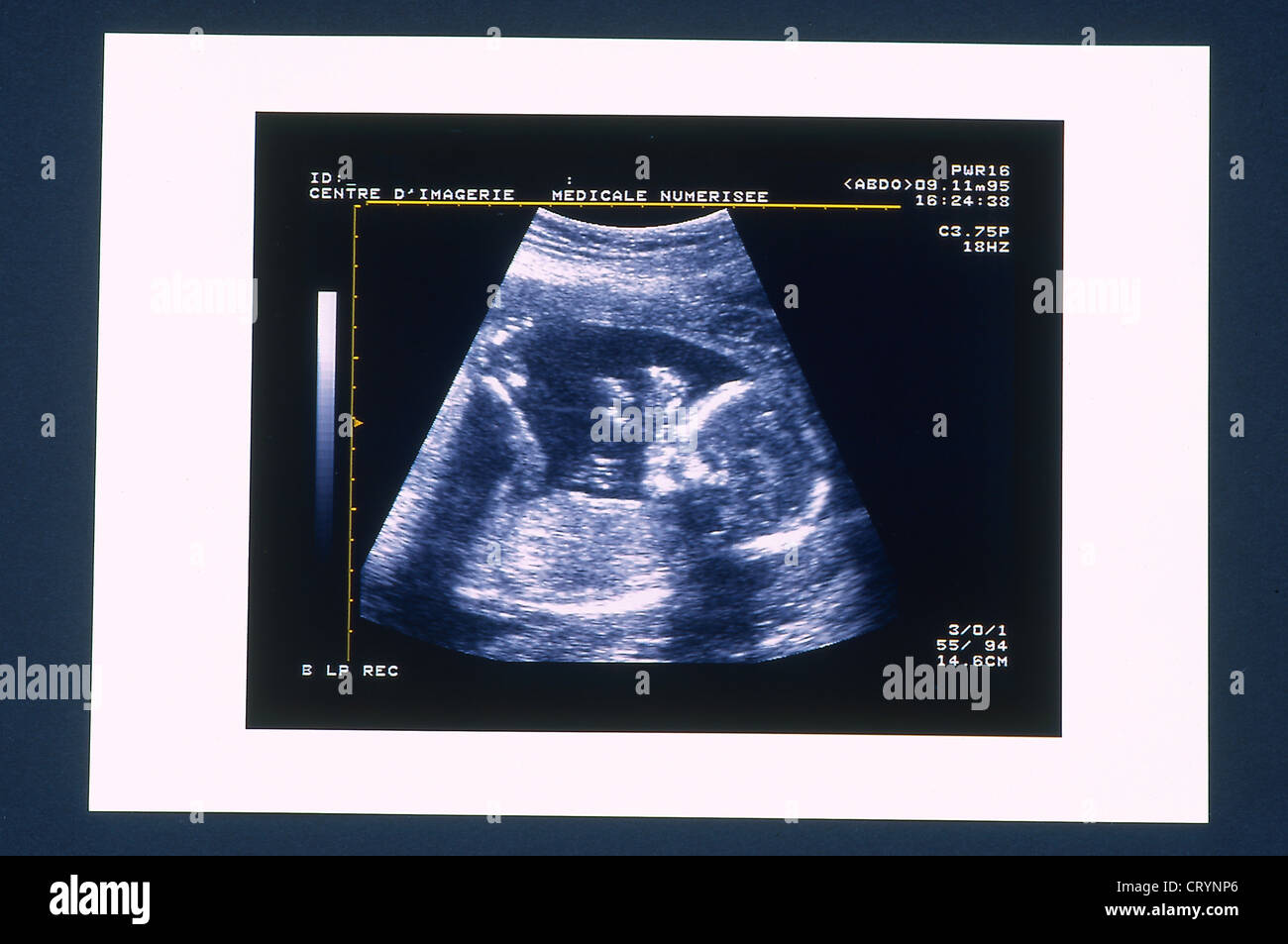 ULTRASOUND BIOMETRY OF THE FETUS Stock Photo - Alamy