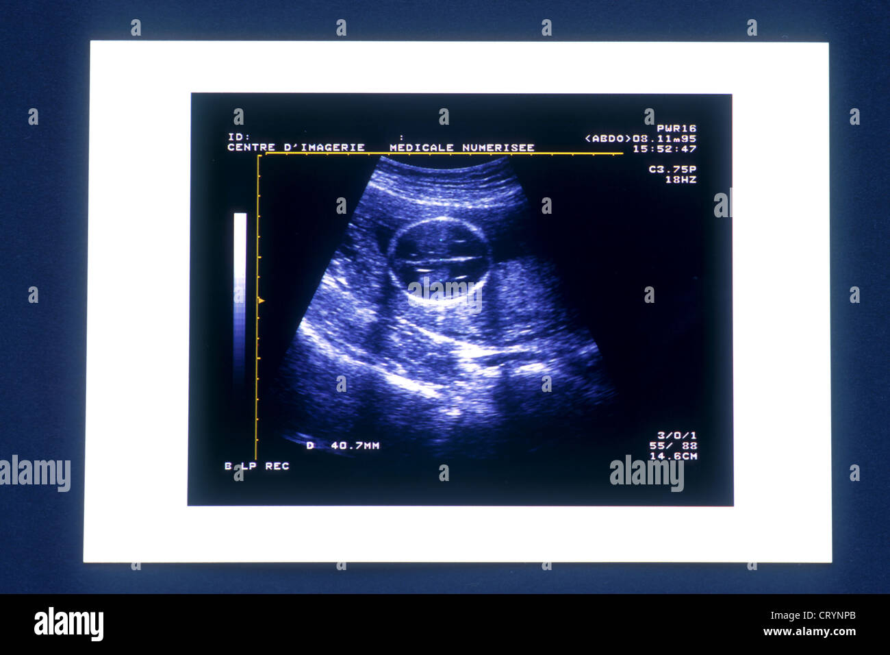 ULTRASOUND BIOMETRY OF THE FETUS Stock Photo - Alamy