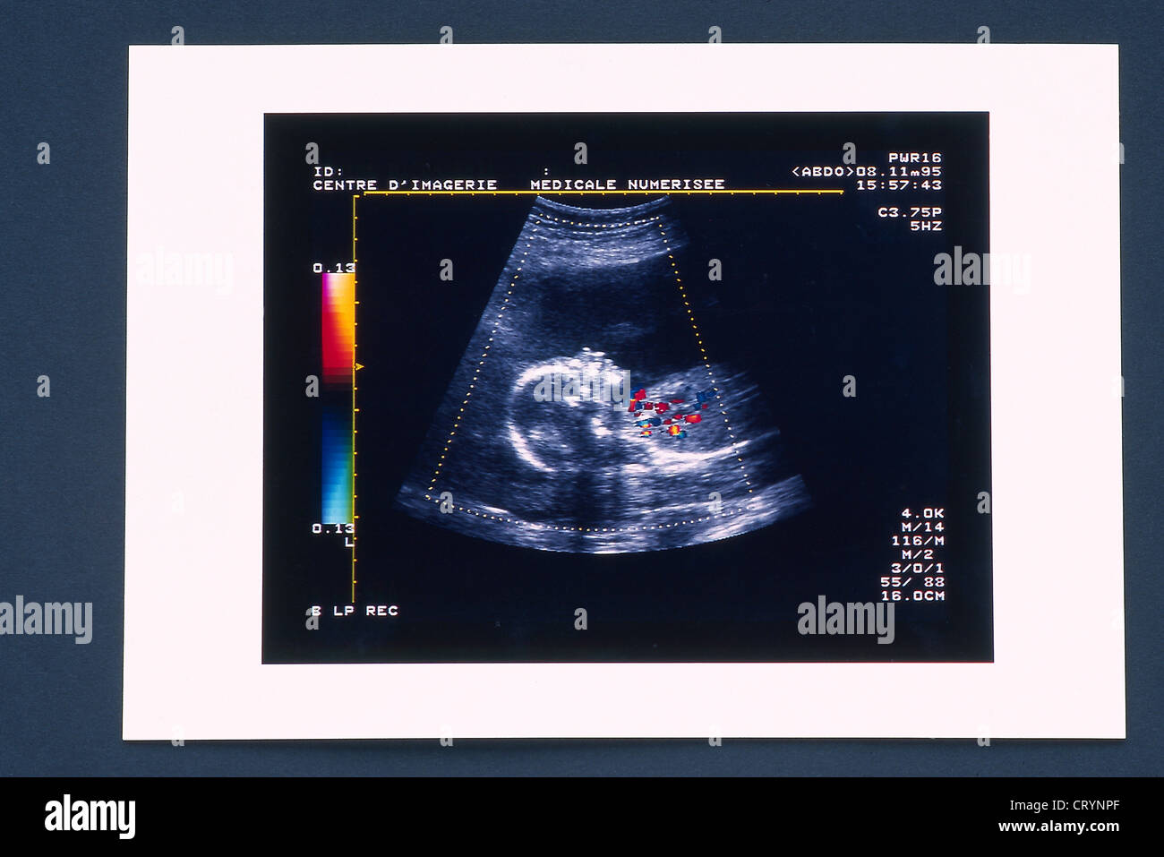 ULTRASOUND BIOMETRY OF THE FETUS Stock Photo - Alamy
