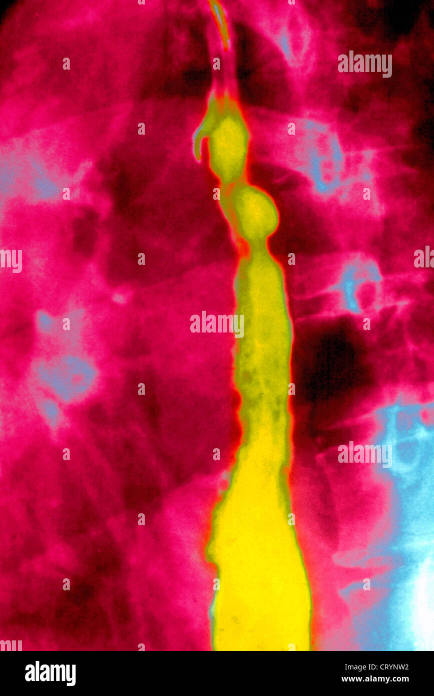 ESOPHAGEAL VARIX, X-RAY Stock Photo - Alamy