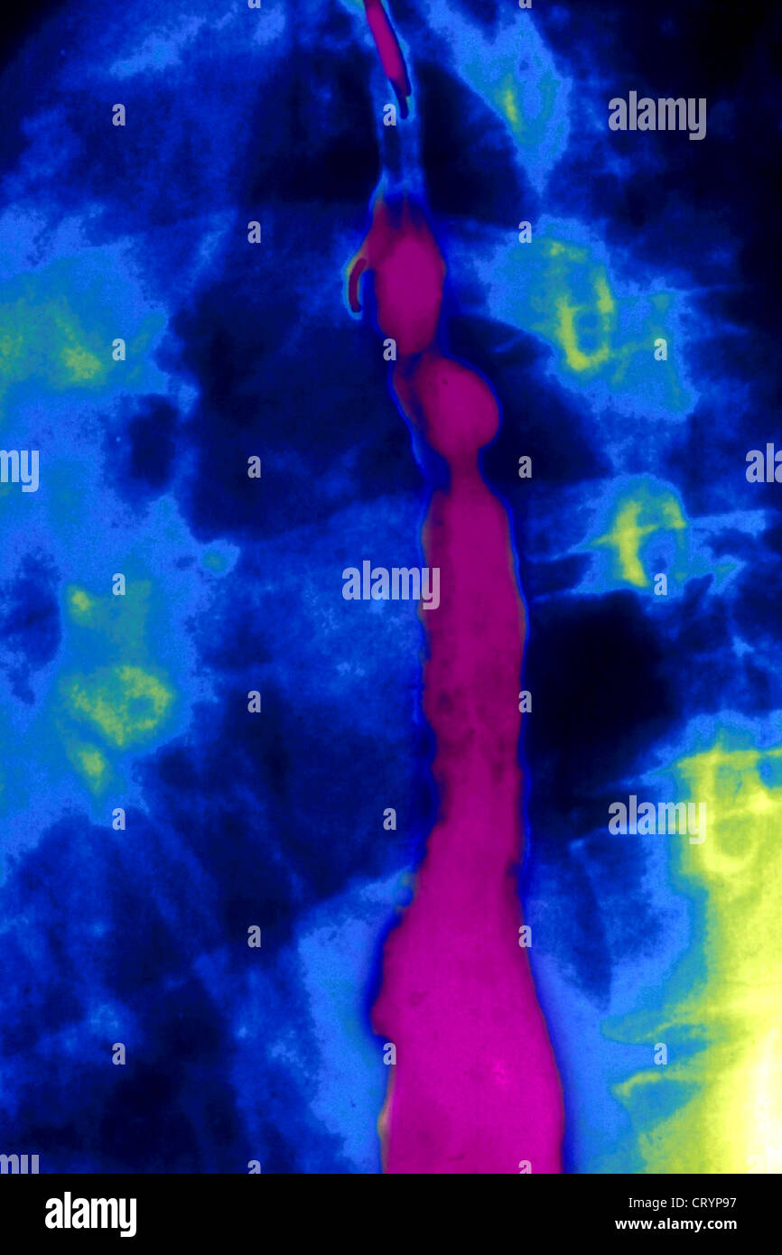 ESOPHAGEAL VARIX, X-RAY Stock Photo - Alamy