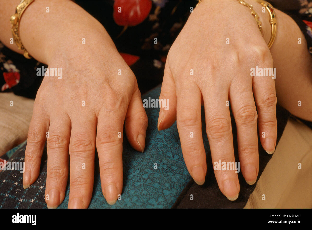 Solar lentigo hi-res stock photography and images - Alamy