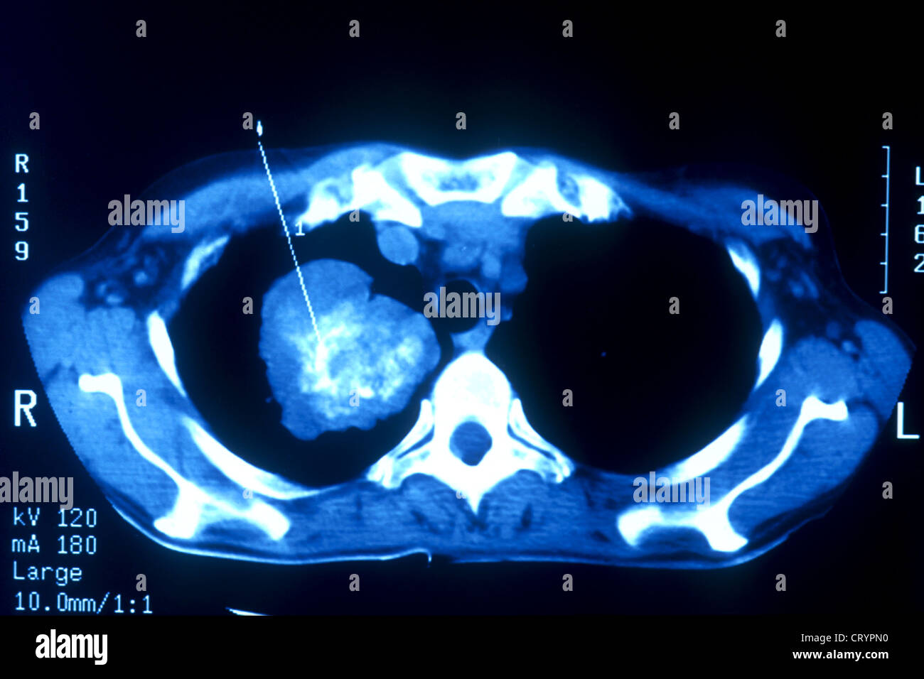 LUNG CANCER, SCAN Stock Photo - Alamy