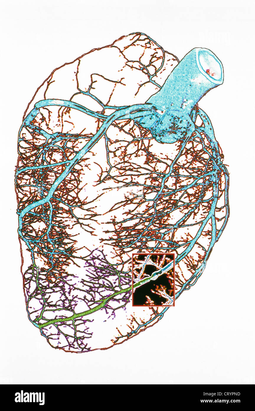 HEART ATTACK, DRAWING Stock Photo - Alamy