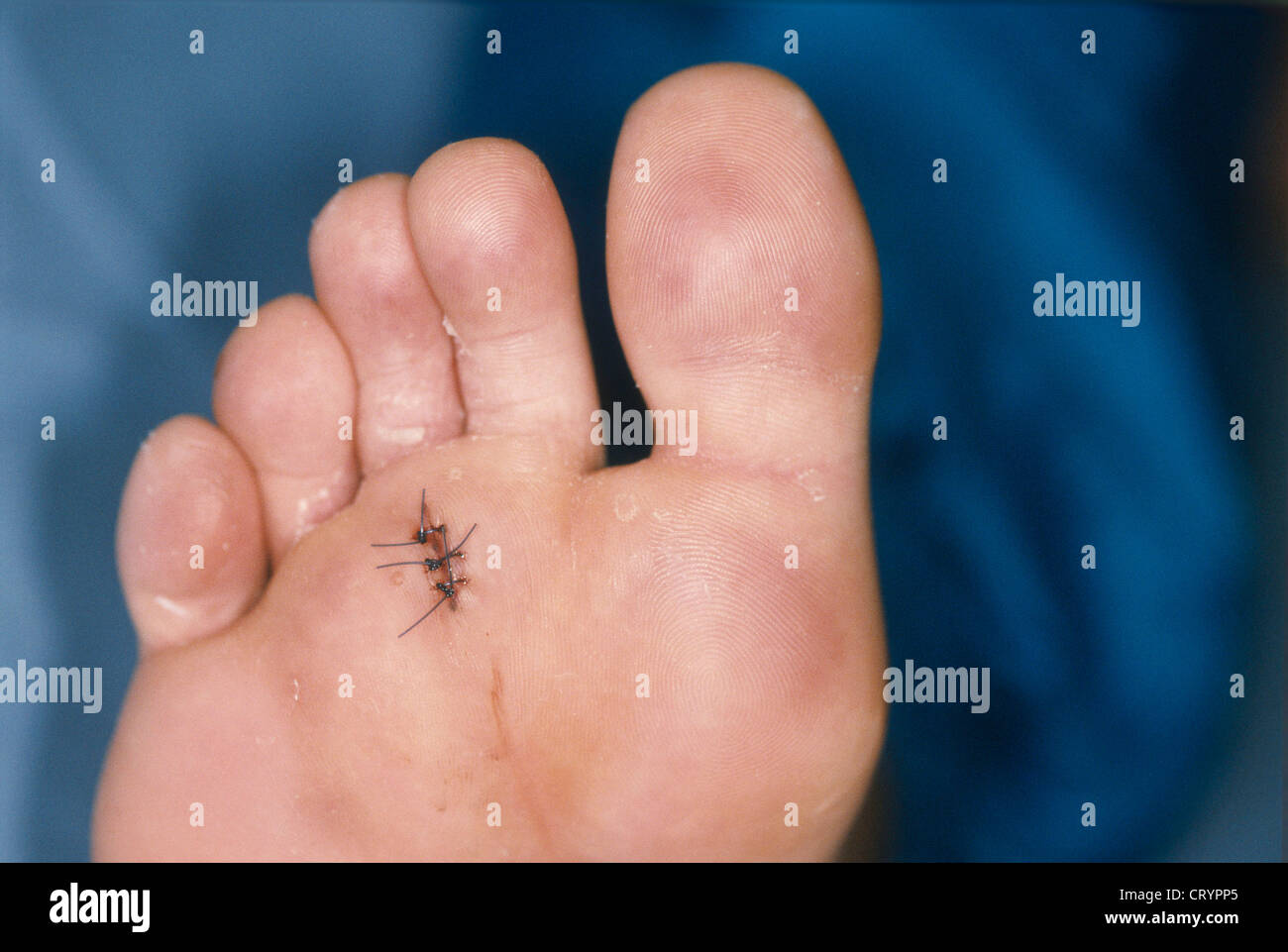 Erythema foot hi-res stock photography and images - Alamy