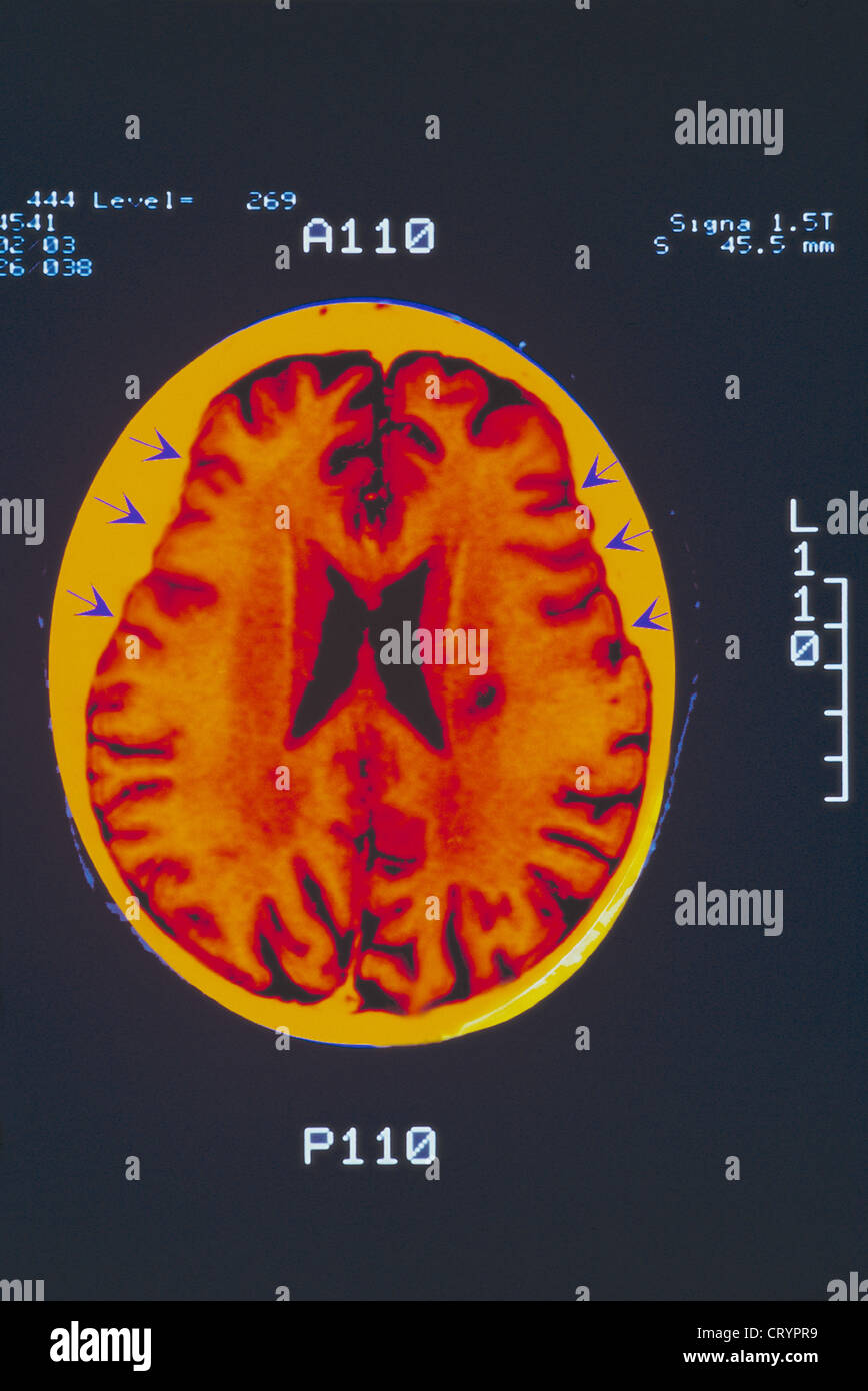 Alzheimer’s disease x ray hi-res stock photography and images - Alamy
