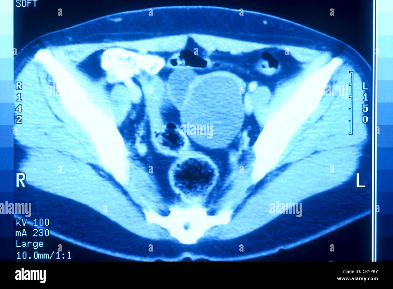 Ovaries scan hi-res stock photography and images - Alamy