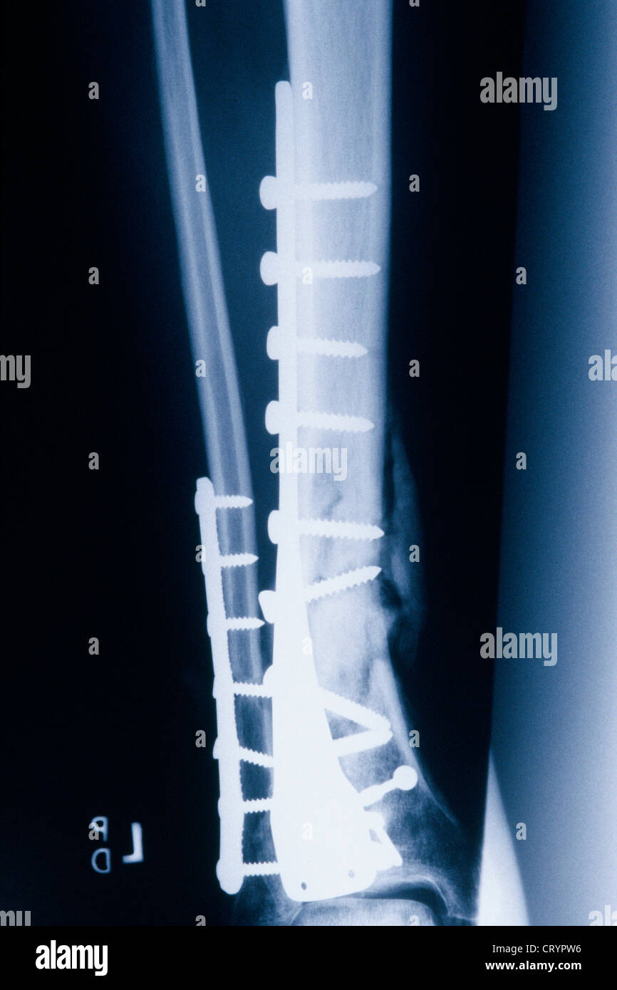 TIBIA OSTEOSYNTHESIS, X-RAY Stock Photo - Alamy