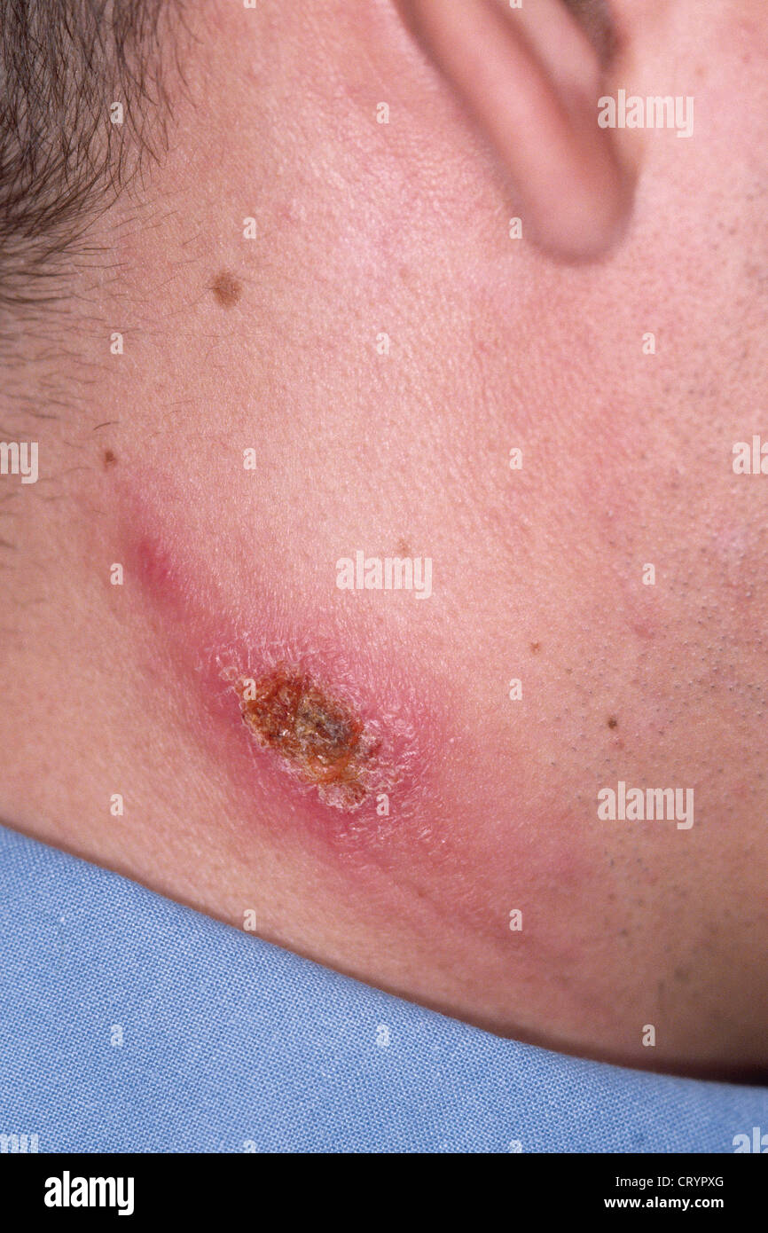 Cutaneous leishmaniasis hi-res stock photography and images - Alamy