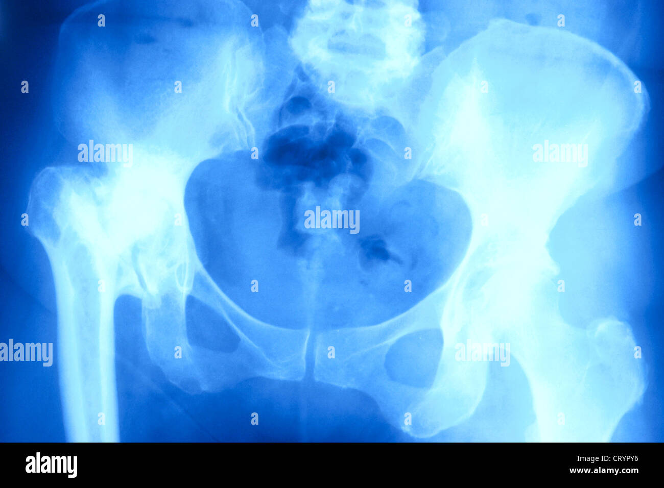 TUBERCULOSIS IN THE BONES, X-RAY Stock Photo - Alamy
