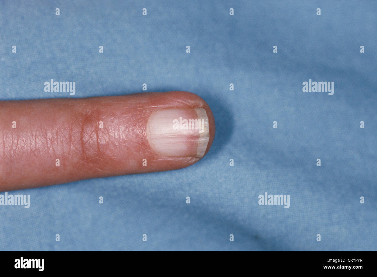 Raynaud's Hand High Resolution Stock Photography and Images - Alamy