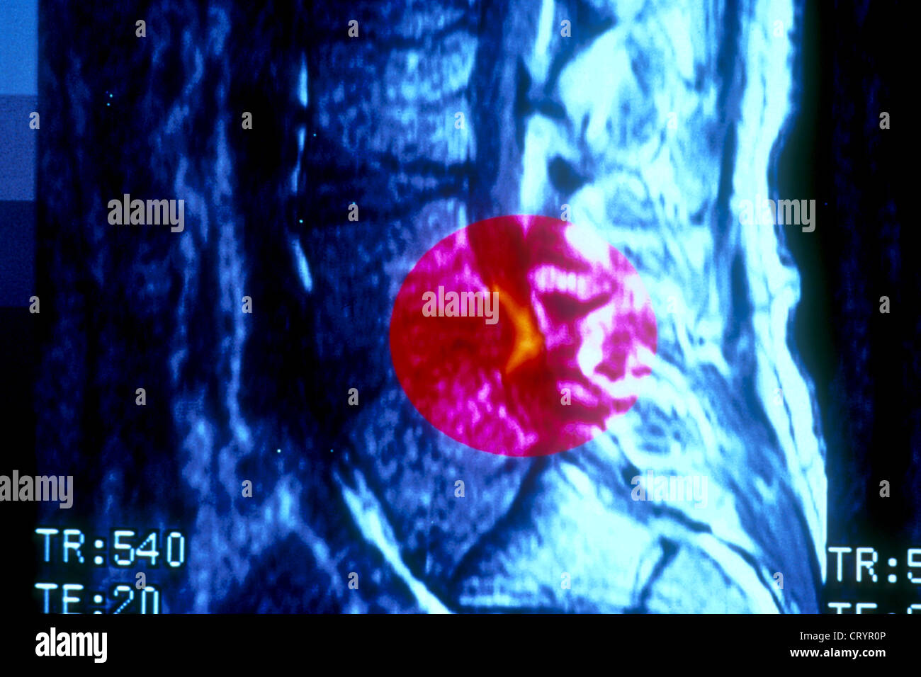 Herniated lumbar disc mri hi-res stock photography and images - Alamy
