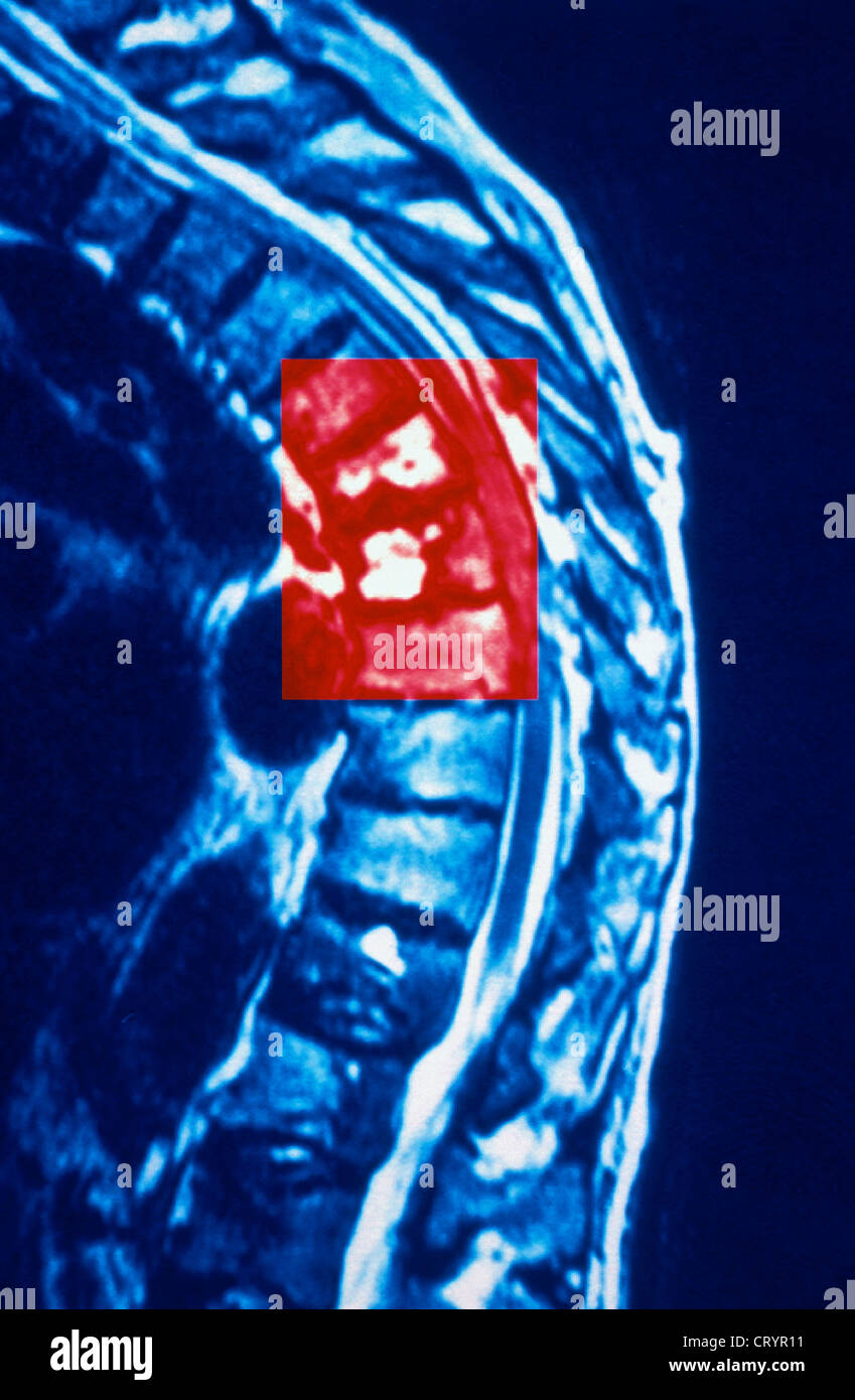 Deformed backbone hi-res stock photography and images - Alamy