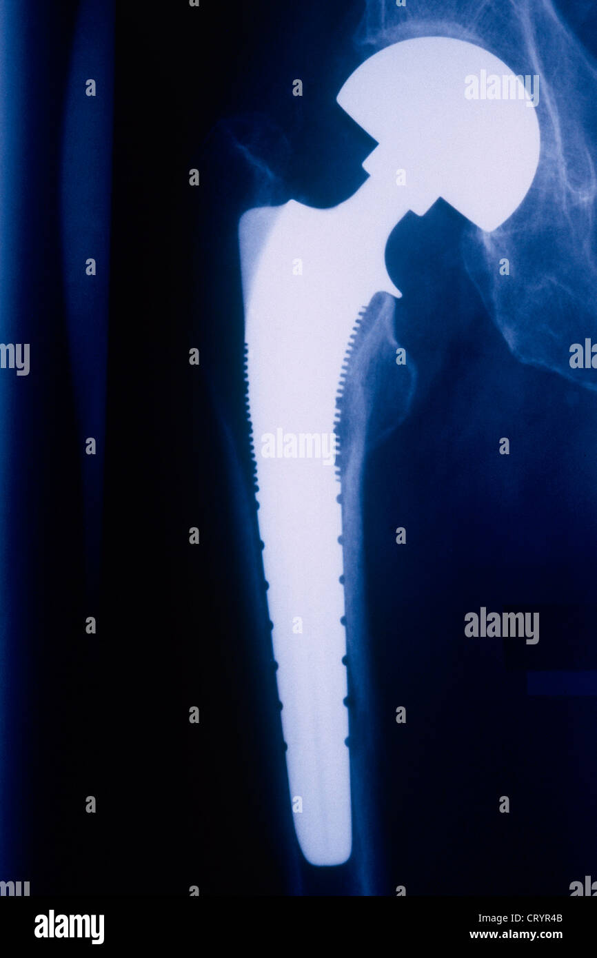HIP PROSTHESIS, X-RAY Stock Photo - Alamy