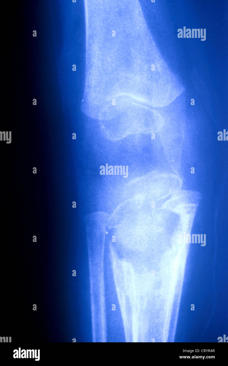 TUBERCULOUS ARTHRITIS, X-RAY Stock Photo - Alamy