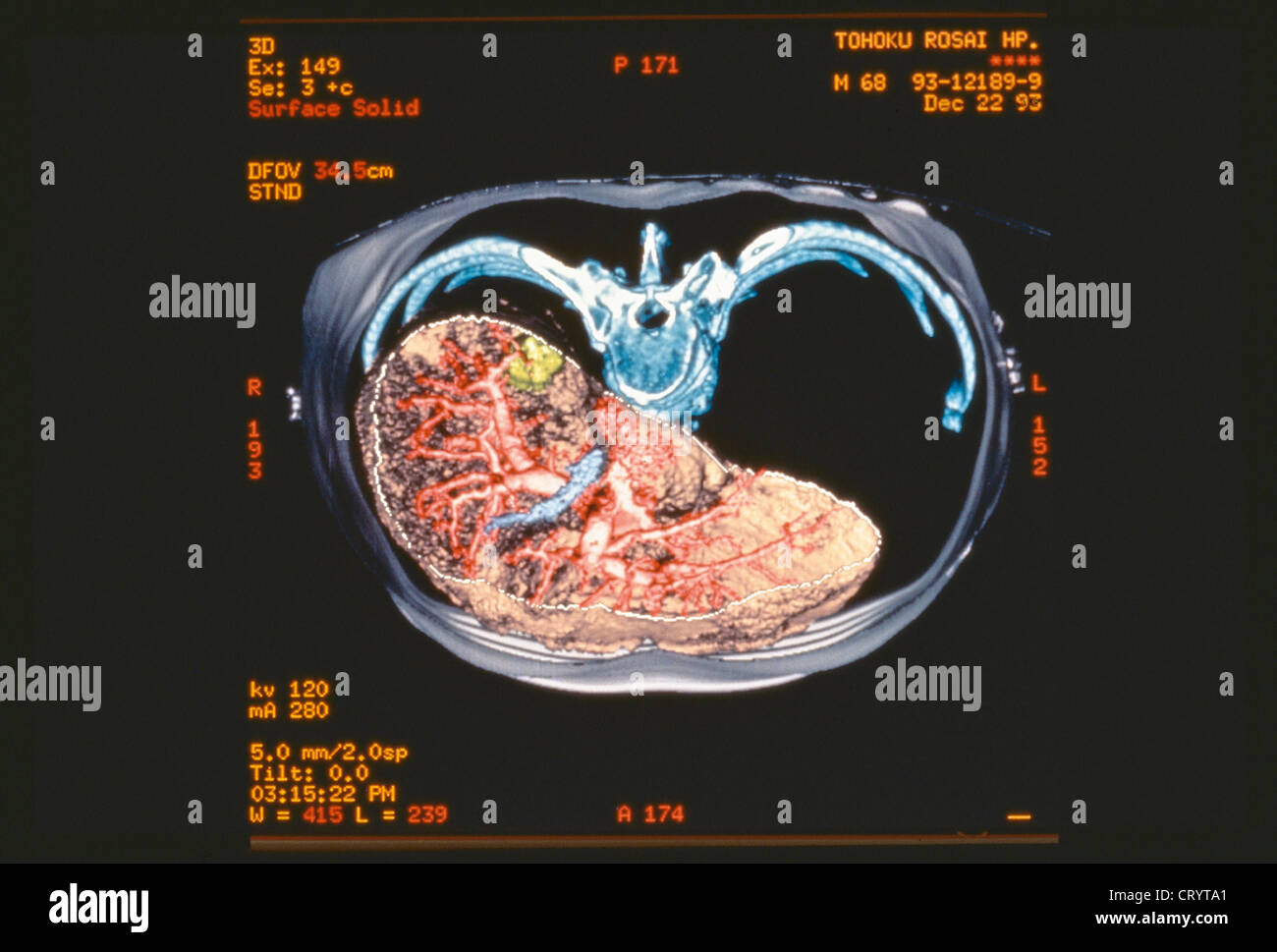 LIVER, SCANNER RESULT Stock Photo - Alamy