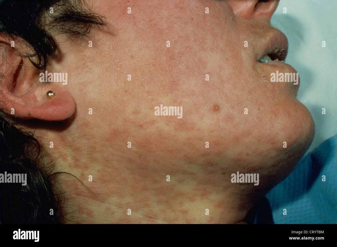 The measles hi-res stock photography and images - Alamy