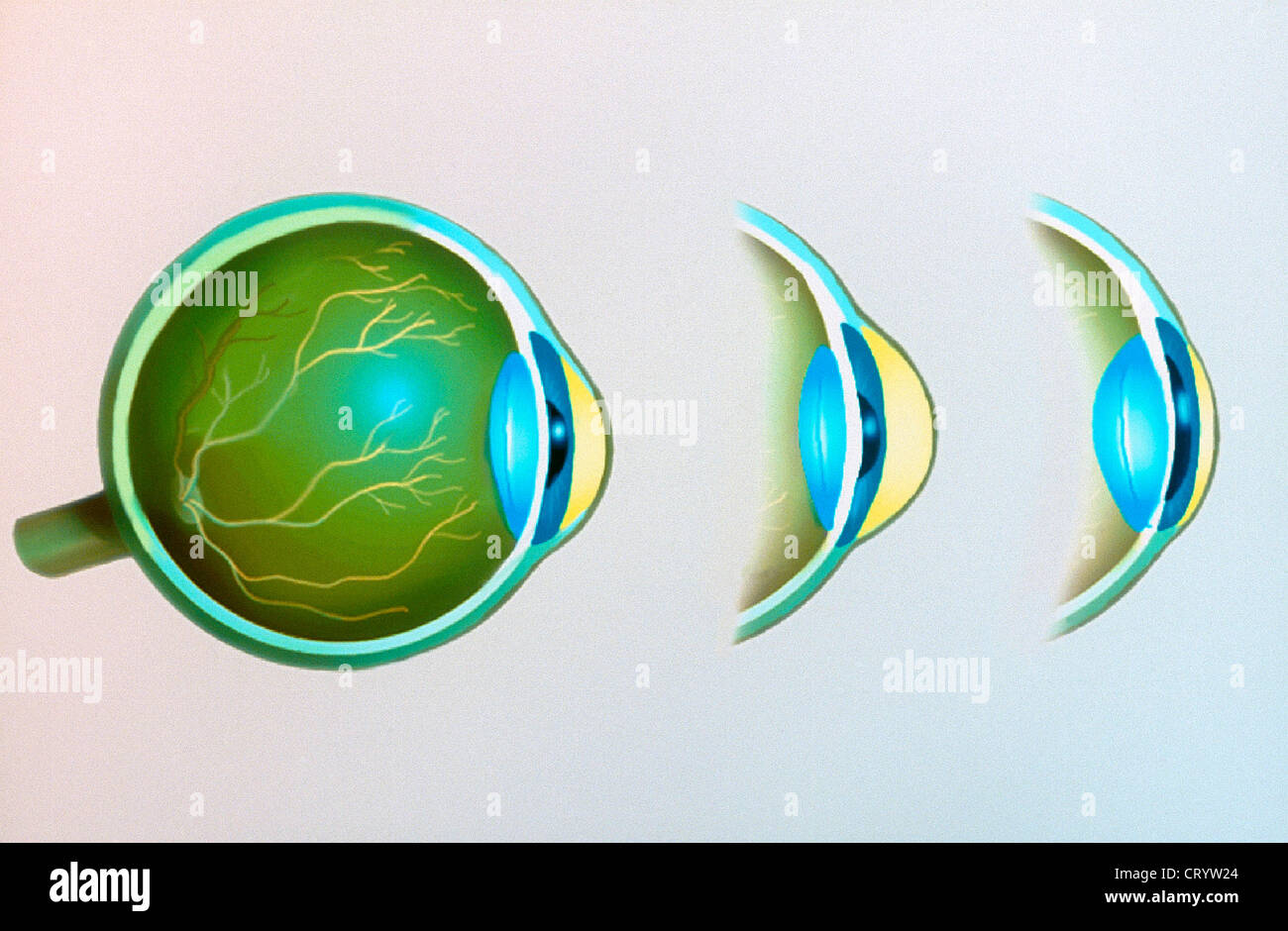 Open angle glaucoma hi-res stock photography and images - Alamy