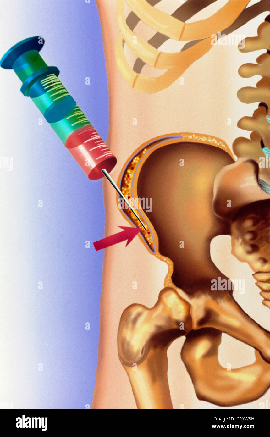 BONE MARROW ASPIRATION Stock Photo Alamy