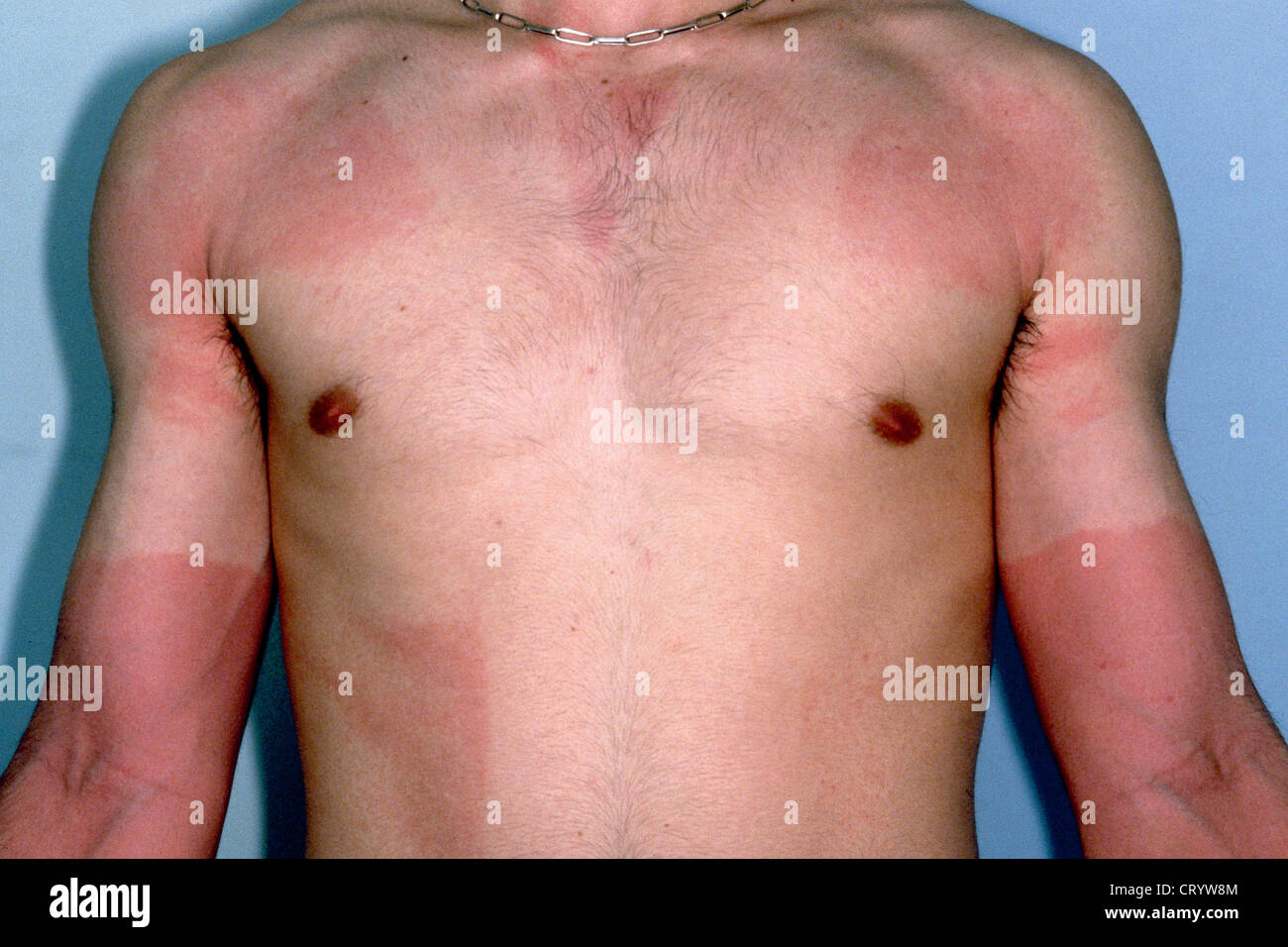 Urticarias High Resolution Stock Photography and Images - Alamy