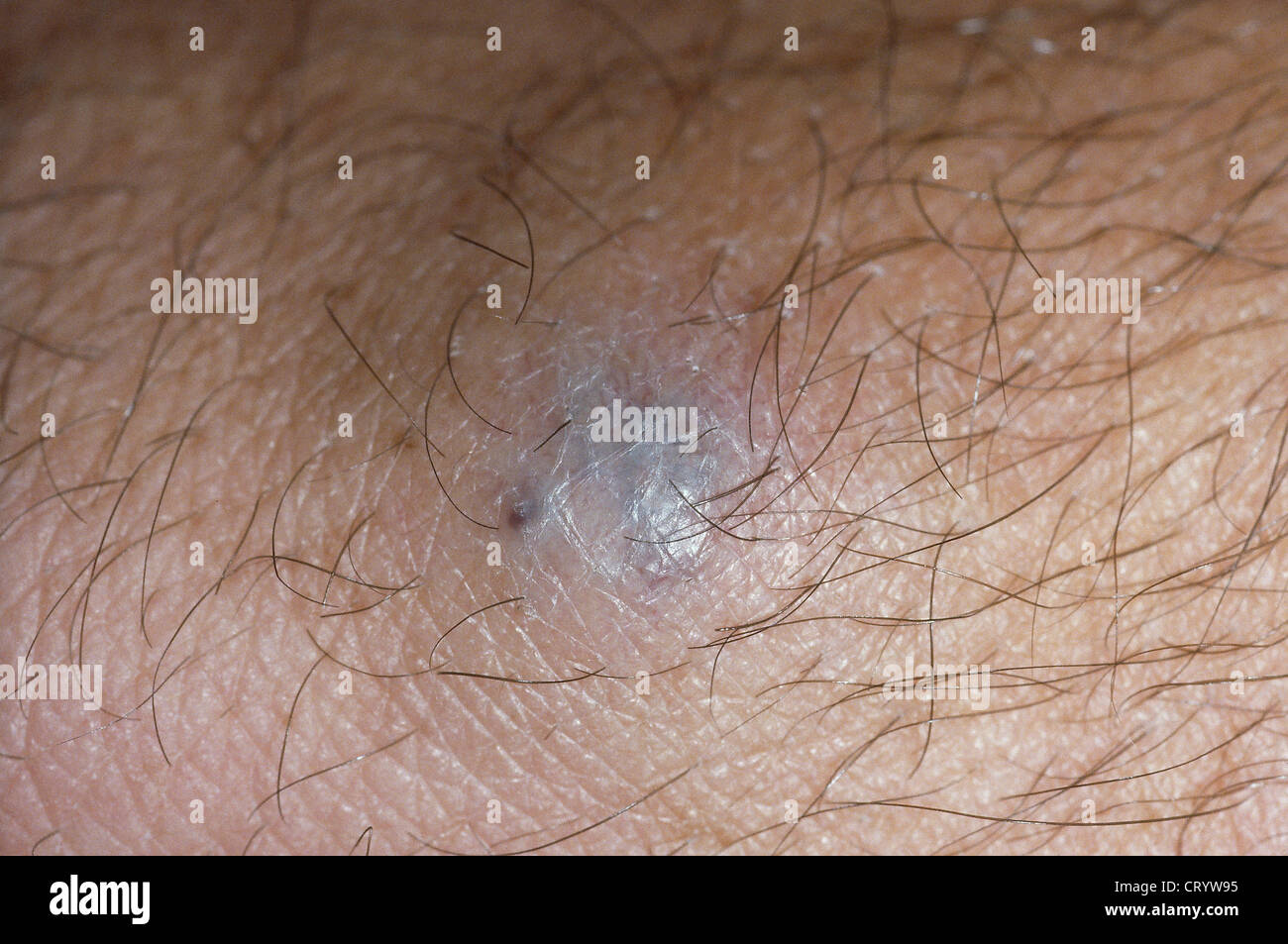 Hemangioma cardiovascular hi-res stock photography and images - Alamy