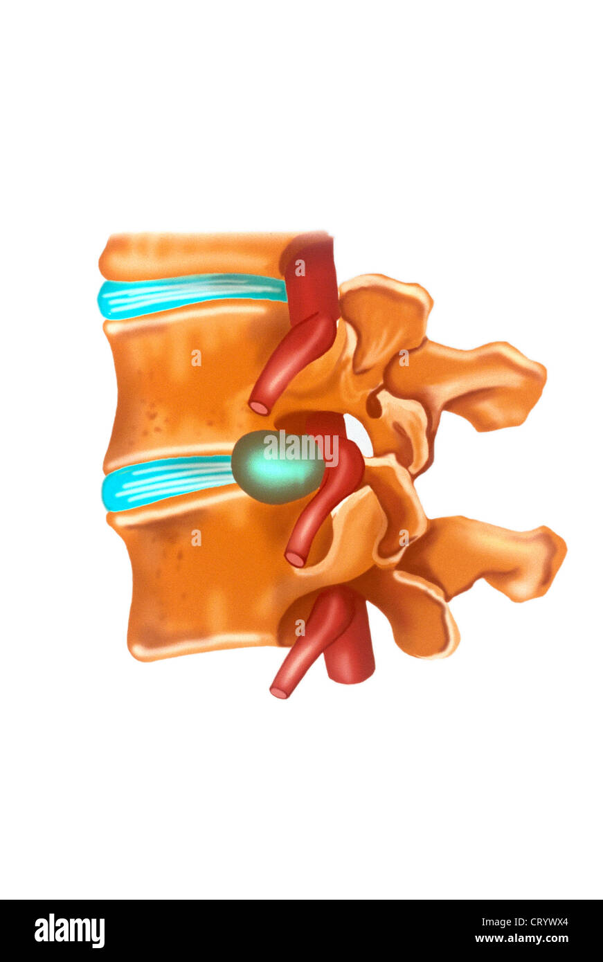 HERNIATED DISK, ILLUSTRATION Stock Photo - Alamy
