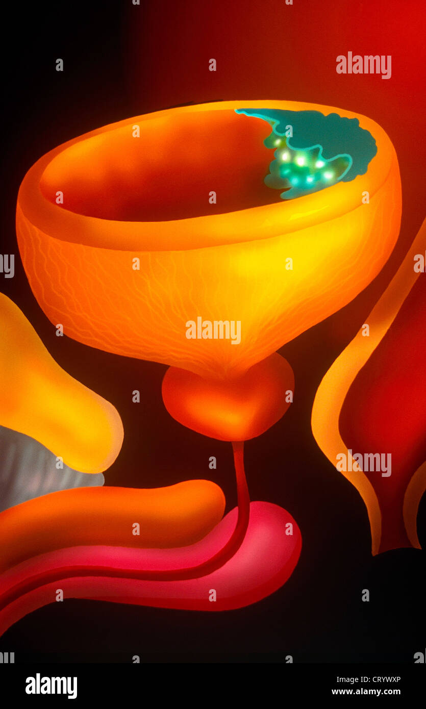 CANCER OF THE BLADDER, DRAWING Stock Photo - Alamy