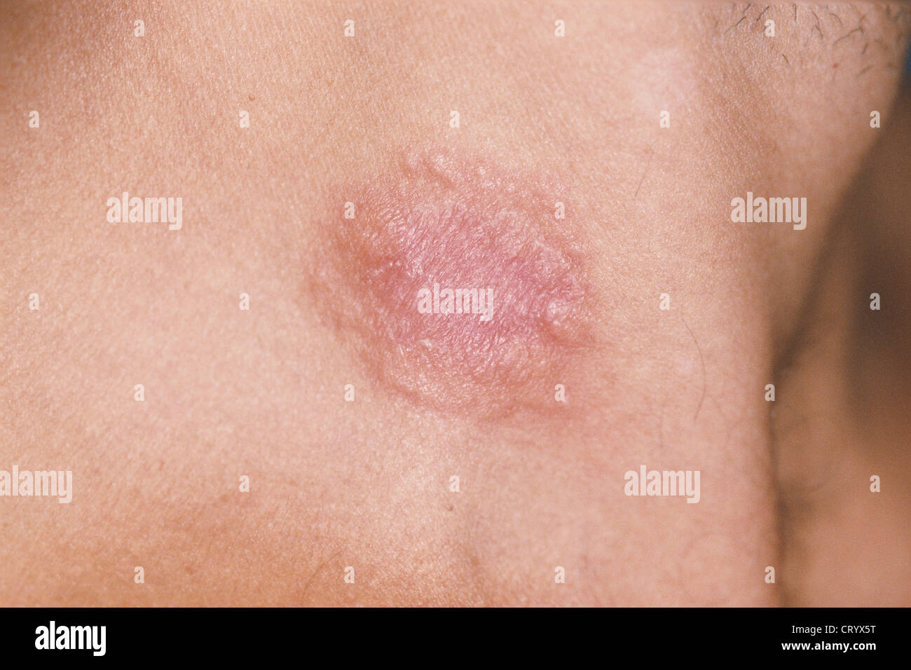 Sweets Syndrome High Resolution Stock Photography and Images - Alamy