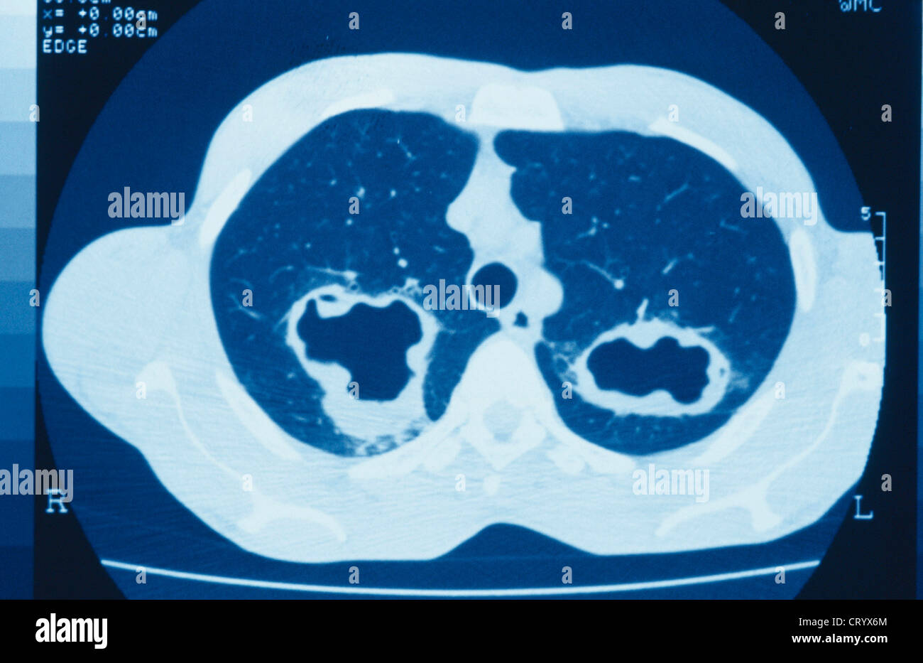 WEGNER'S DISEASE, SCAN Stock Photo - Alamy