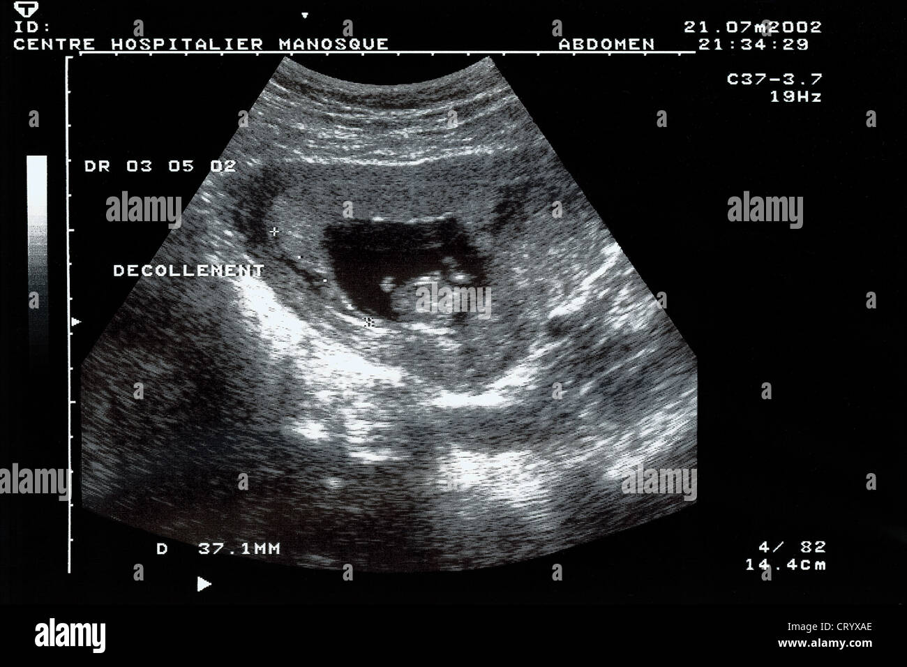 ULTRASOUND BIOMETRY OF THE FETUS Stock Photo - Alamy