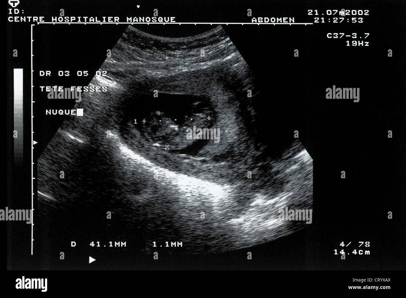 ULTRASOUND BIOMETRY OF THE FETUS Stock Photo - Alamy