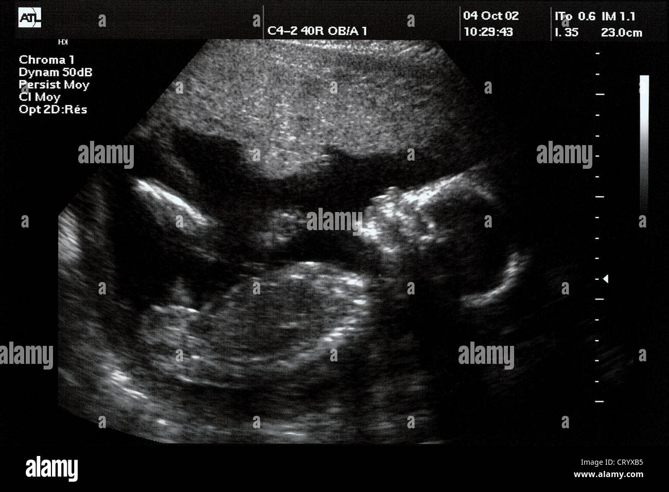 ULTRASOUND BIOMETRY OF THE FETUS Stock Photo - Alamy