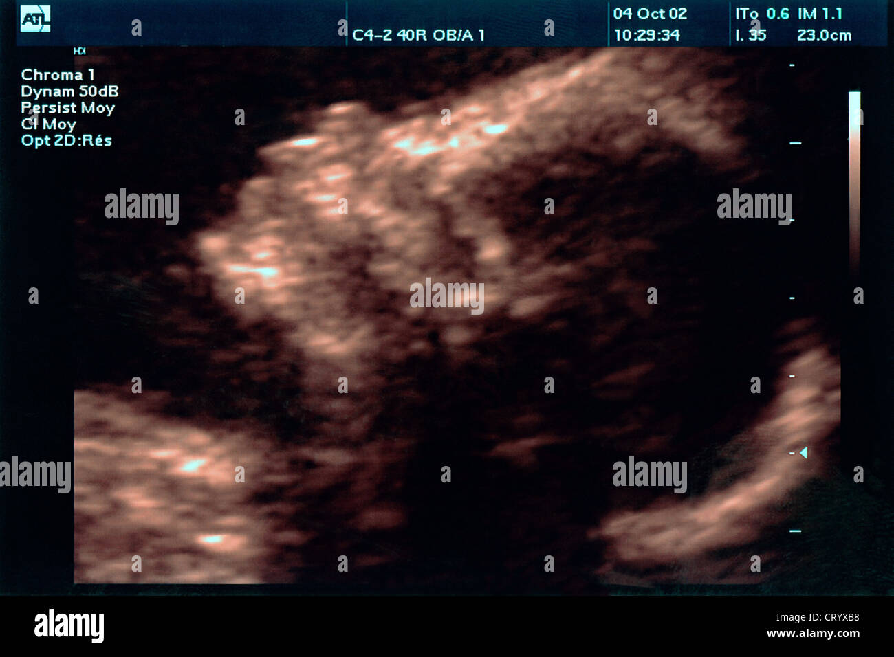 22 weeks fetus hi-res stock photography and images - Alamy