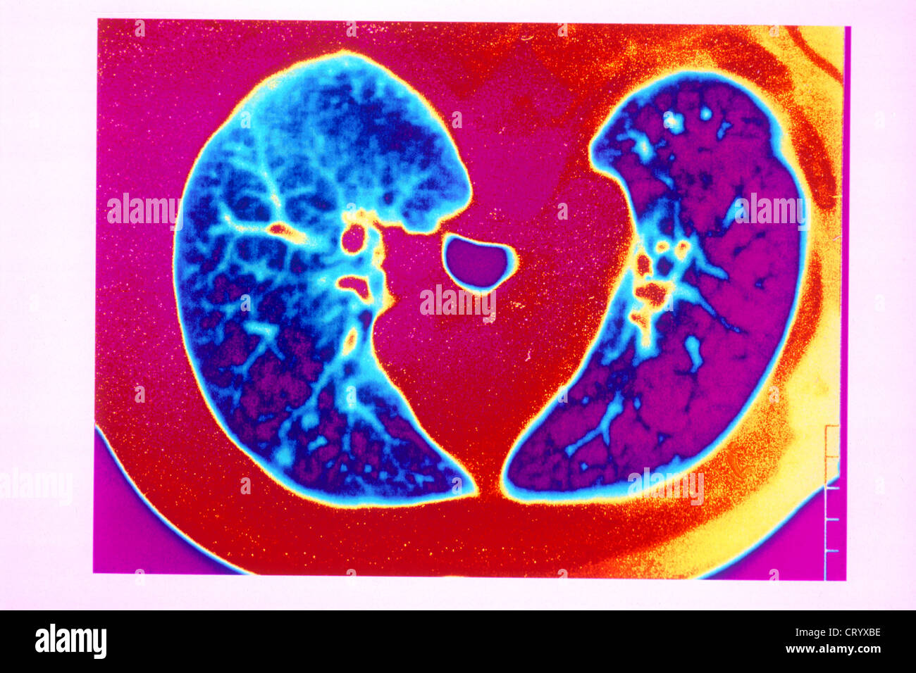 LUNG SCAN FOR EMPHYSEMA Stock Photo - Alamy